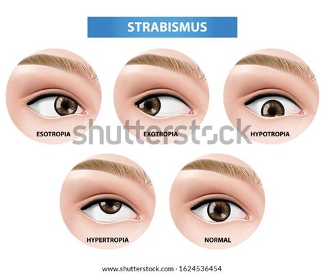 Strabismus Crossed Eye Vector Illustration Stock Vector Royalty Free