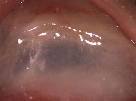 Pseudomembranous Conjunctivitis Unveil The Curtain Bmj Case Reports