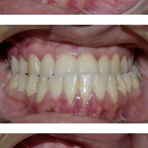 Initial Occlusion Severe Class Iii Malocclusion Download Scientific
