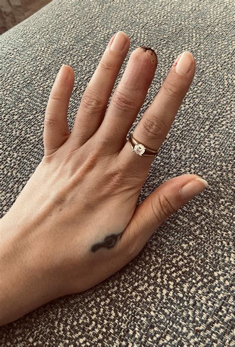 1 Month Post Amputation Getting Easier To Copy With By The Day I Cannot Thank This Community