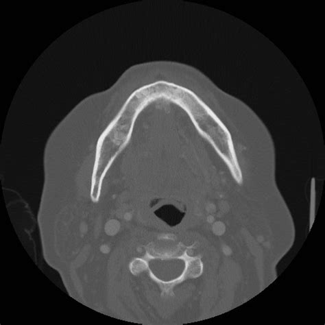 Mandibular Osteomyelitis Radiology Ct At Marcus Vanhoose Blog