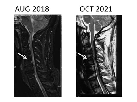 Adjacent Segment Diseasepptx Physical Therapy Wellness