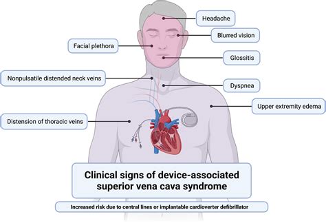 3 Cases Of Superior Vena Cava Syndrome Following Percutaneous Right