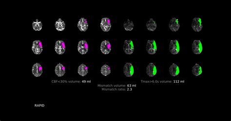 Ct Perfusion Image Analysis Software For Stroke Rapidai