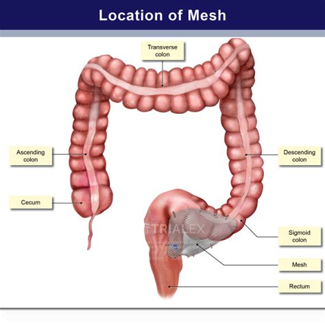 Location Of Mesh Near Rectum And Sigmoid Colon Trialexhibits Inc My