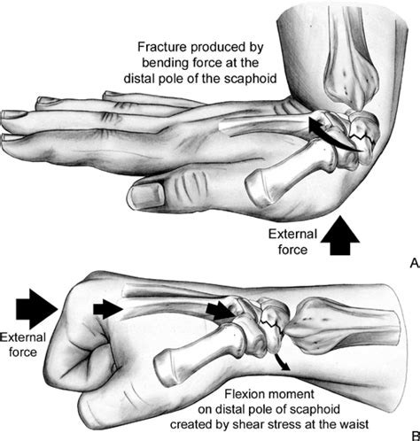 Scaphoid Tubercle