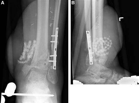 A And B Anteroposterior And Lateral Radiographs Of The Ankle After