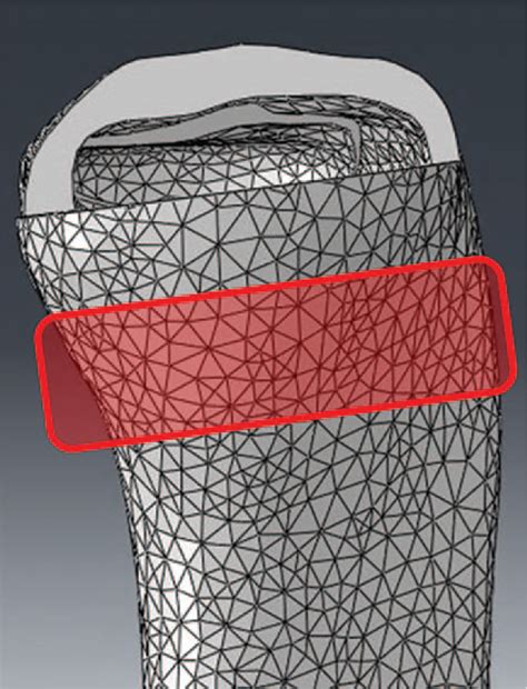 The Effect Of Malalignment On Proximal Tibial Strain In Fixed Bearing