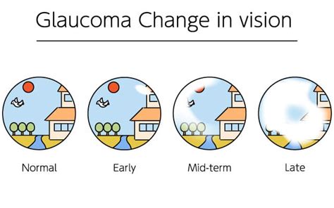 Glaucoma Utah Eye Centers