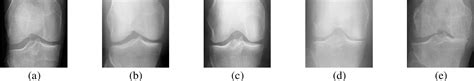 Figure 1 From Knee Osteoarthritis Automatic Detection Using U Net Semantic Scholar