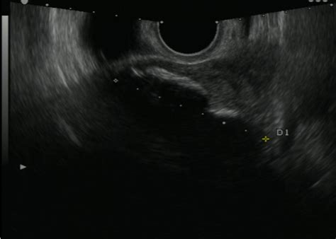 A “stone Like” Leiomyoma Causing Uterine And Bowel Perforation Eurorad