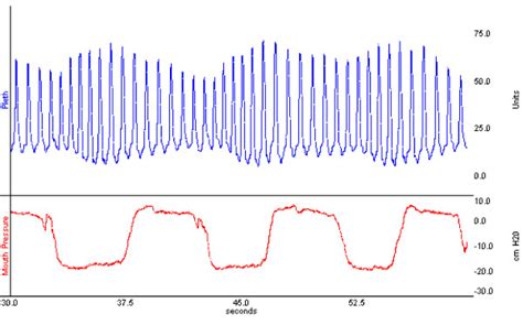 Oximeter Plethysmographic Waveform Pleth Generated With Inspiratory Download Scientific