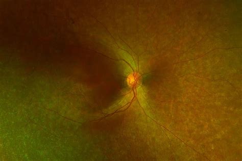 Ophthalmic Gene Therapy Subretinal Injection Learn And Share Leica