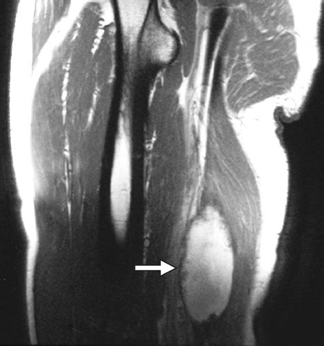Pulled Hamstring Mri