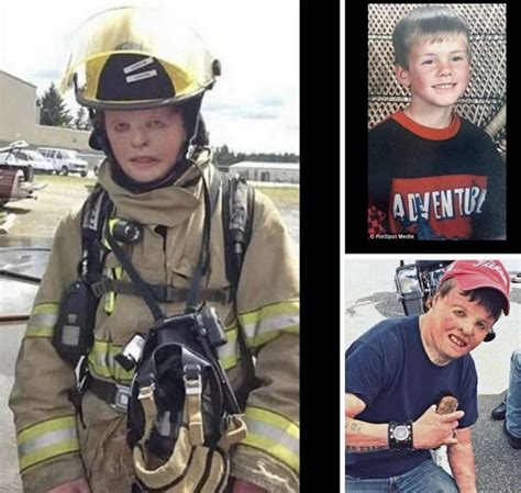 여섯 살 때 몸의 70에 화상을 입었던 아이짱공유 명예의 쩐당