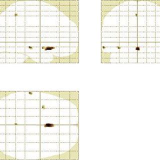 Statistical Parametric Map Output For Voxel Based Morphometry VBM On Download Scientific