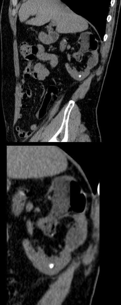 Emphysematous Pyelonephritis The Common Vein