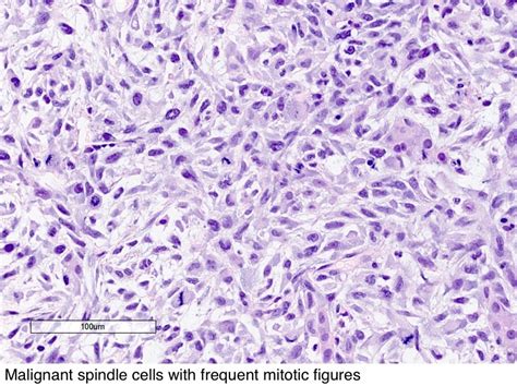 Cholangiocarcinoma Pathology Outlines