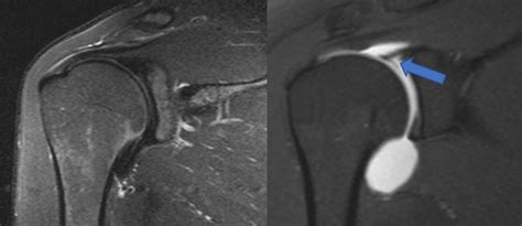 Lumbar Puncture Spine Procedure Series Mediphany