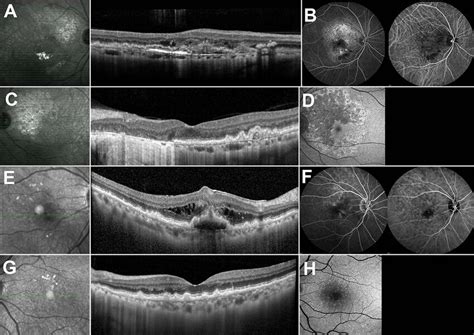 Histology Of Type Macular Neovascularization And 47 Off
