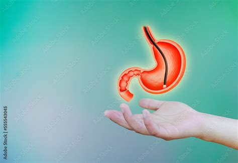 Endoscopic Biopsy Esophagogastroduodenoscopy Egd Hand Holds Human