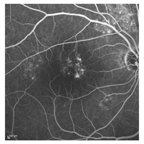 Diagnosis Of Polypoidal Choroidal Vasculopathy Pcv In A Case Of