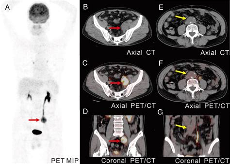 Coexistence Of Fdg Avid And Fdg Negative Aneurysms In A Pati