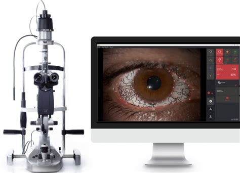 Innovative Anterior Grading System The Latest Great Advance In Ocular… Gordon J Thomas