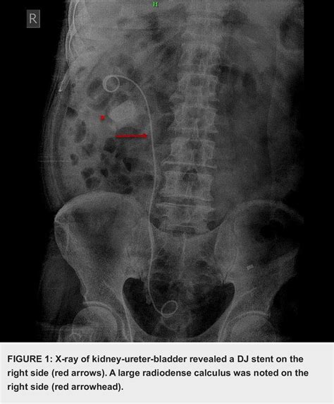 Figure 1 From Ct As A Diagnostic Tool For Emphysematous Pyelitis A Case Report Semantic Scholar