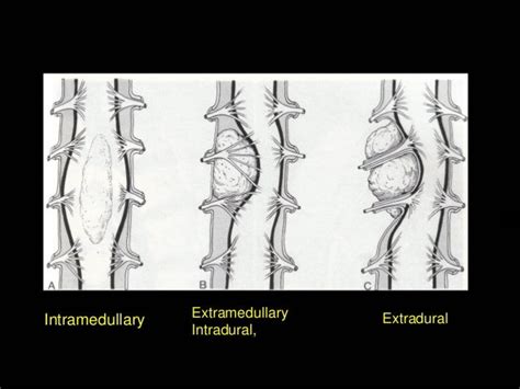 Spinal Tumors Imaging