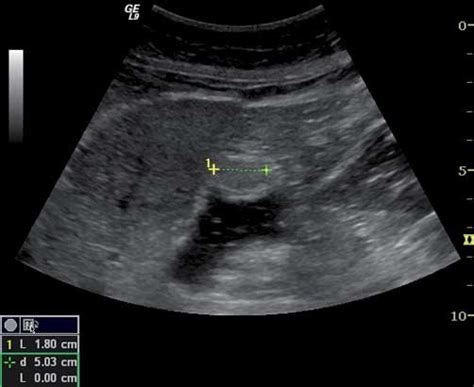 Ultrasonogram Of Gist In The Anterior Wall Of The Gastric Antrum The