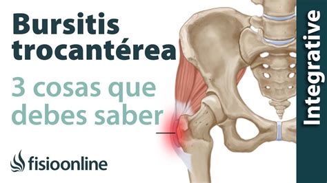 Trocanteritis O Bursitis Trocantérea Tres Cosas Que Debe Saber
