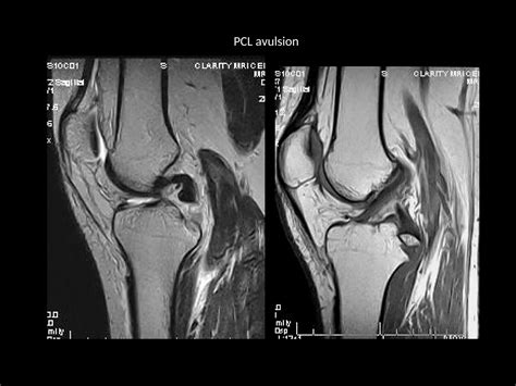 Mri Of The Knee Acl Pcl Mensicus And Collaterals Ppt