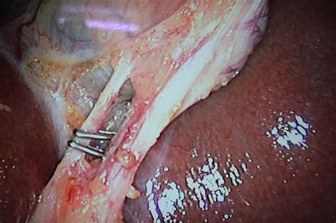 Laparoscopic Cholecystectomy