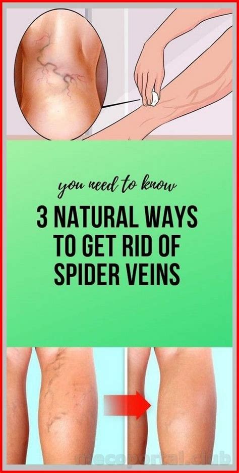 How To Get Rid Of Spider Veins Artofit