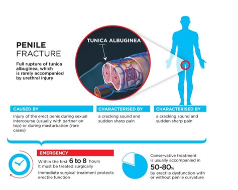 Types Of Penile Curvatures Peyronies Disease
