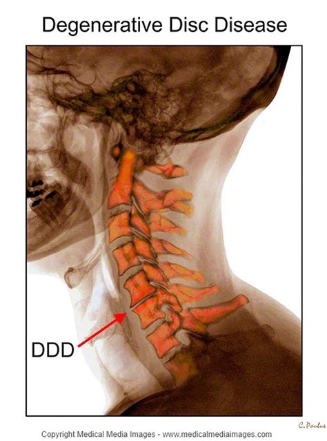 Tear In Disc In Neck Mapageprek