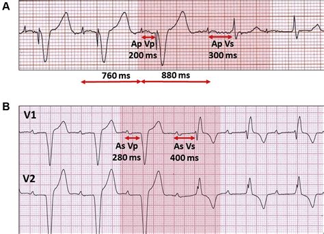 Electrocardiographic Interpretation Of Pacemaker Algorithms Enabling