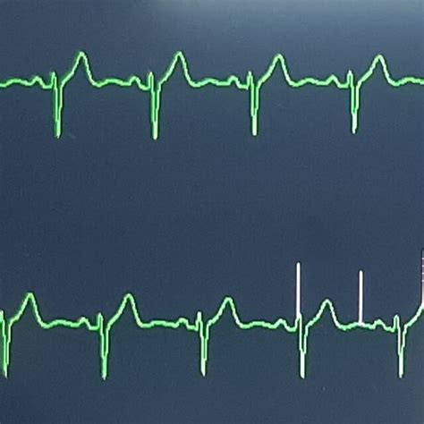 Intraoperative Ecg Showing Induced Type 1 Brugada Pattern This Picture