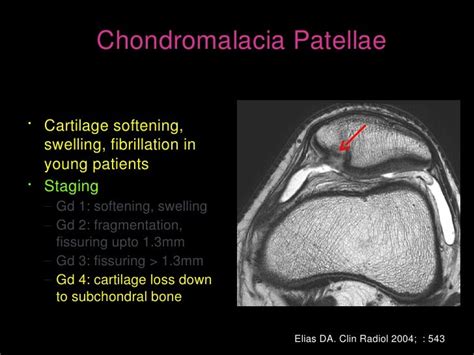 Mri Of Patellar Disorders