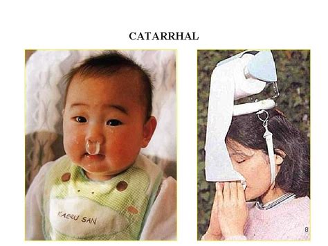 Morphological Patterns Of Inflammation 1 Patterns Acute Inflammation