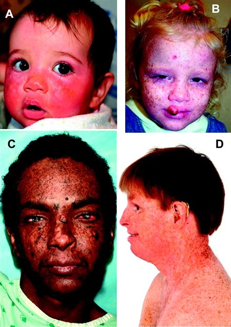 Cancer And Neurologic Degeneration In Xeroderma Pigmentosum Long Term