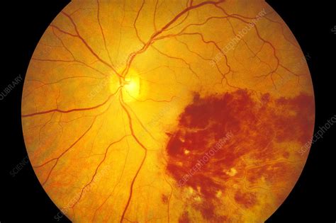 A Fundus Photograph Showing Superficial And Deep Retinal Hemorrhages My Xxx Hot Girl
