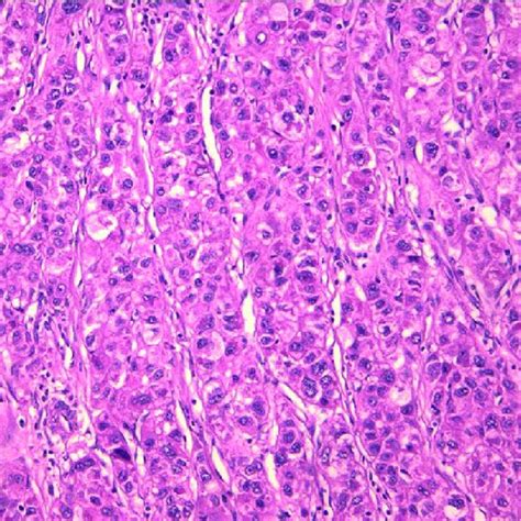 The Pathology Slide From The B Lesion Revealed Glandular Structures