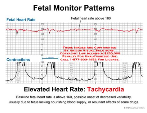 Fetal Monitor Patterns
