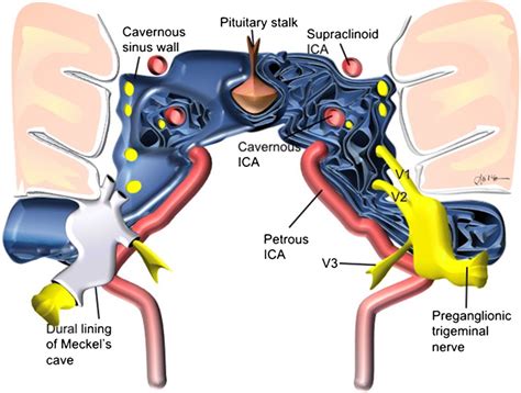 Neuroimaging Of Meckels Cave In Normal And Disease Conditions
