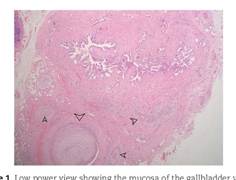 figure 1 from polyarteritis nodosa presenting as cholecystitis—a case report semantic scholar