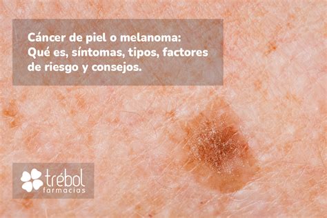 Cáncer De Piel O Melanoma Qué Es Síntomas Tipos Factores De Riesgo Y Consejos Para El