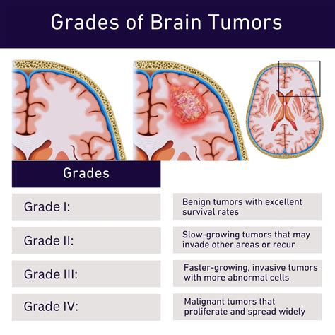 Brain Tumors