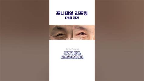 더스완성형외과 포니테일 수술 Youtube